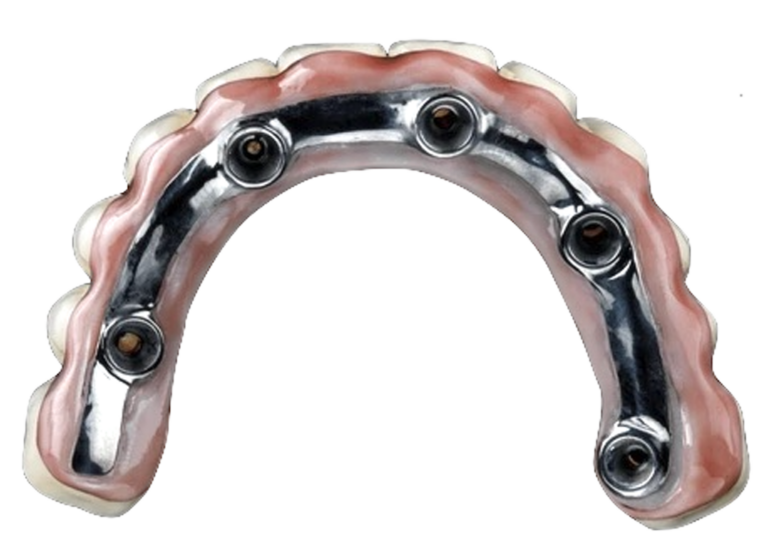 Full Arch | Ottawa Dental Laboratory | IL, IN, & WI