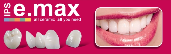 IPS Emax | Ottawa Dental Laboratory